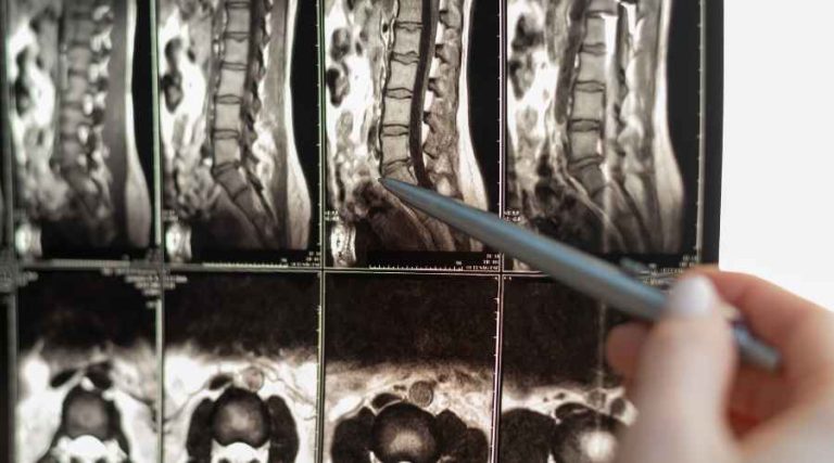 Stenosi lombare: gli esercizi per camminare senza fastidi | Fisiosocial